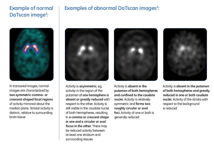 DaTscan | GE Healthcare