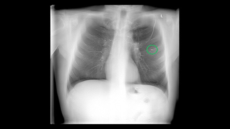 New Clinical Indication | GE Healthcare