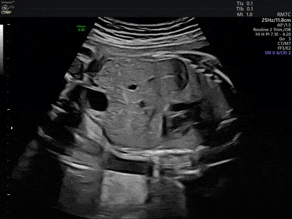 Voluson Expert Series BT21 | GE Healthcare (India)