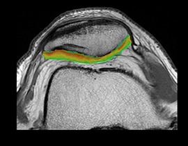 CartiGram | GE HealthCare (India)