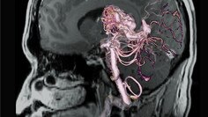 Interventional Advanced Visualization | GE Healthcare (India)